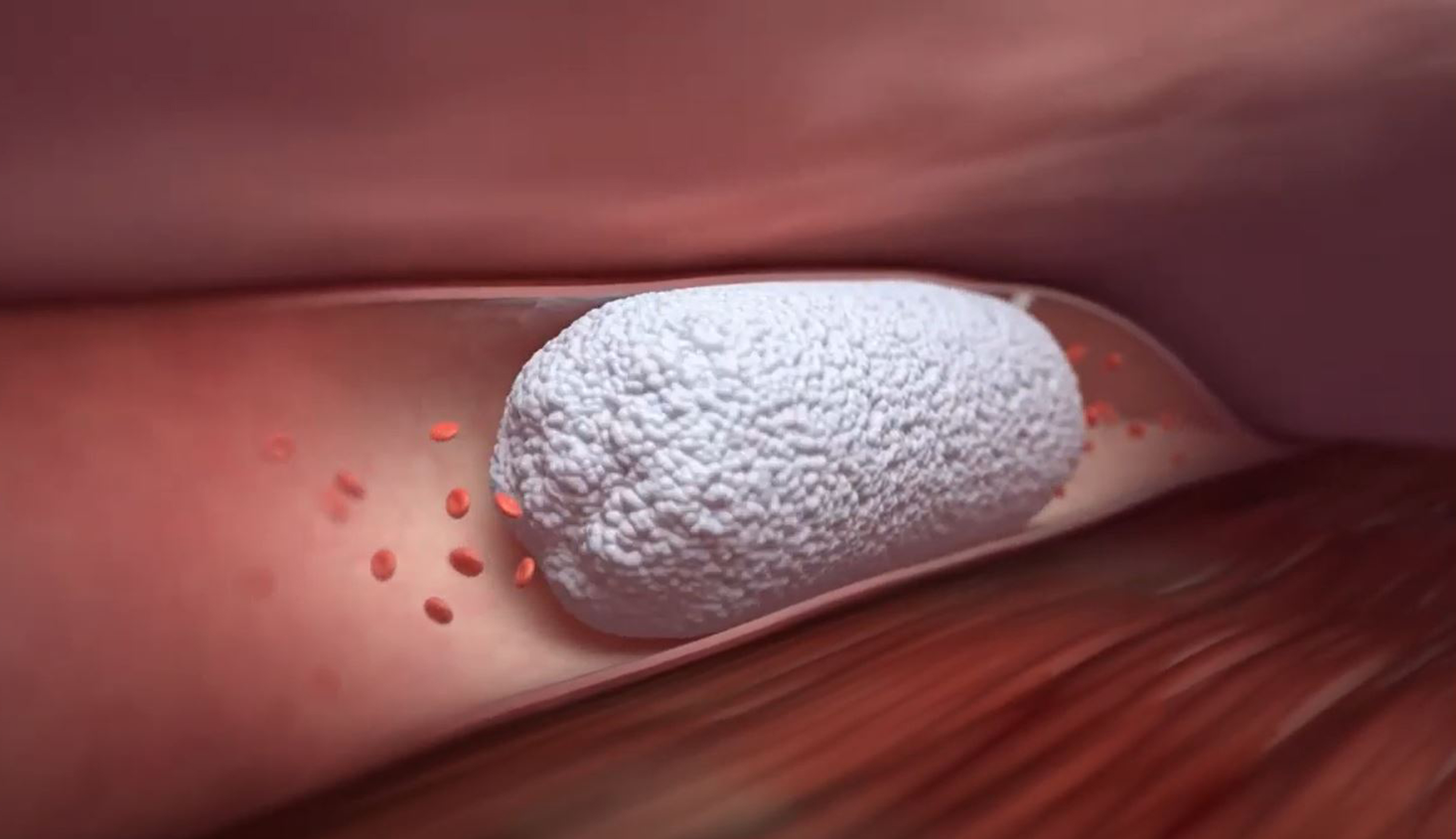 How It Works: Understanding the Treatment Process | Varithena®