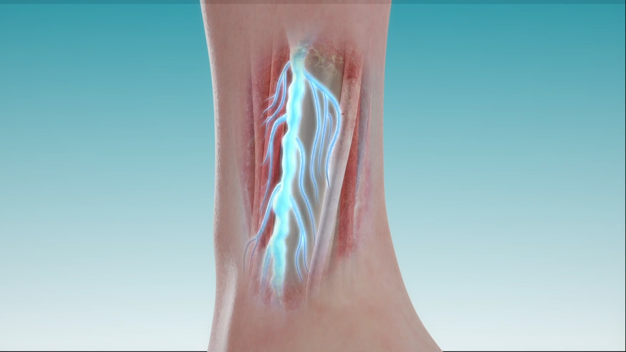 Venous Leg Ulcers: Key Findings from VIEW-VLU | Varithena®