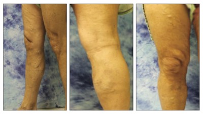 Advancing GSV Ablation with Injectable Foam | Varithena™