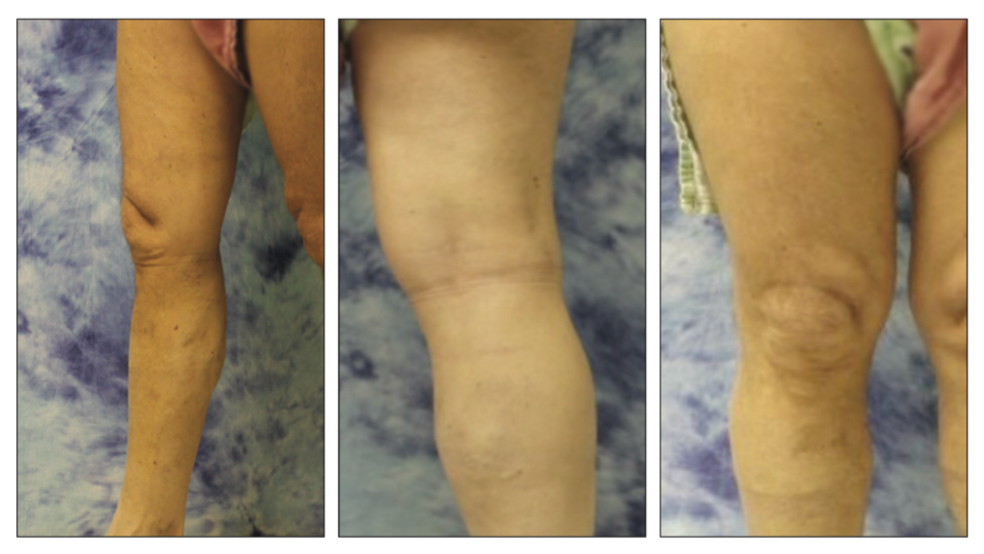 Advancing GSV Ablation with Injectable Foam | Varithena™