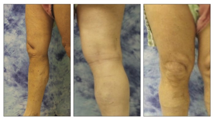 Advancing GSV Ablation with Injectable Foam | Varithena™