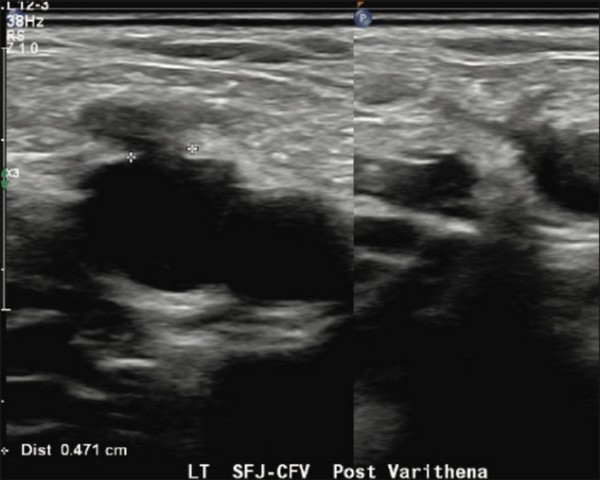 Advancing GSV Treatment with Polidocanol Foam | Varithena™