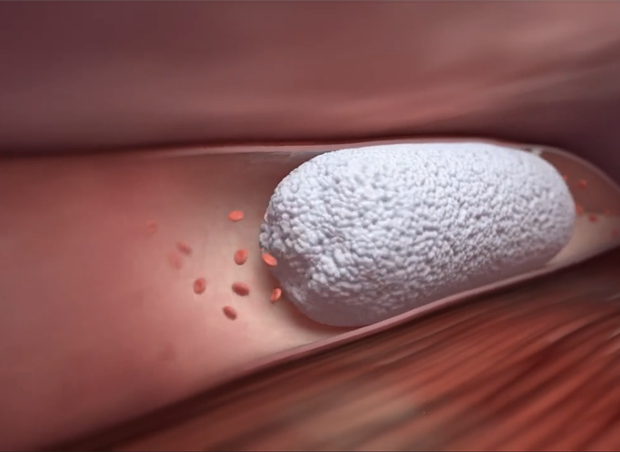 HCPs: Discover Varithena’s Innovative Vein Treatment | Varithena™