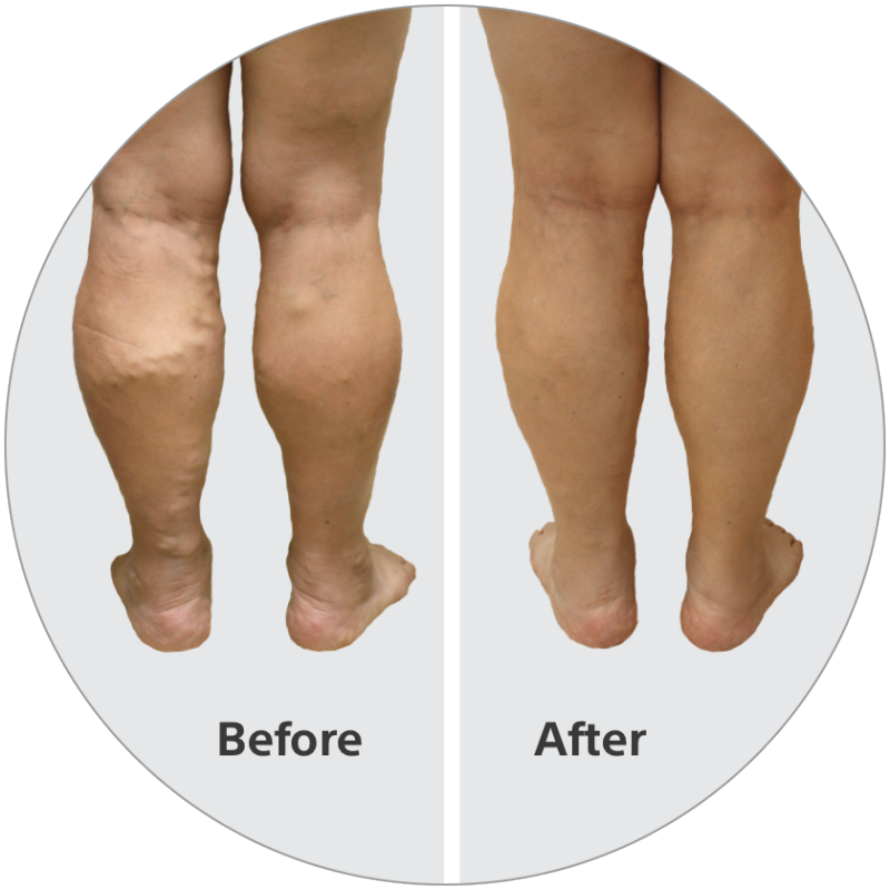A non-surgical treatment for varicose veins | Varithena™