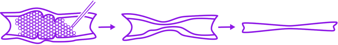 What is the Varithena treatment process? - Varithena